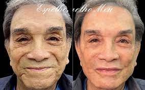 Aos 86 anos, Dedé Santana faz harmonização facial; veja resultado ...